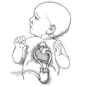 Ventricular Assist Device | The Daily Omnivore